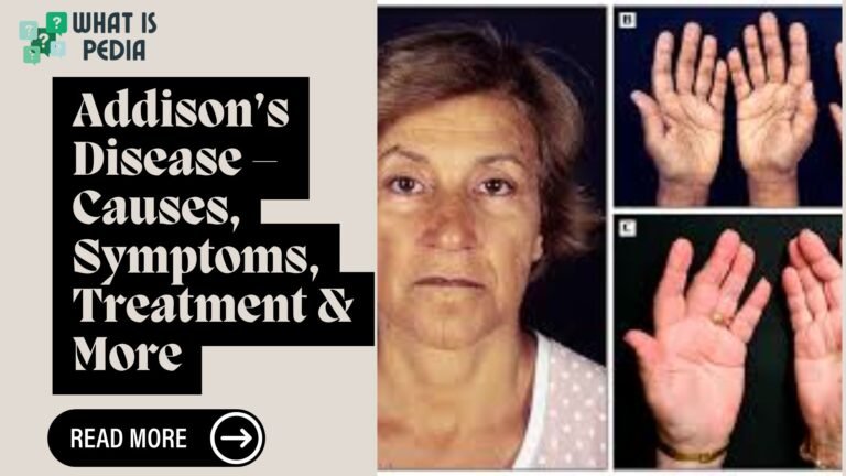 Addison’s Disease: Causes, Symptoms & Treatment